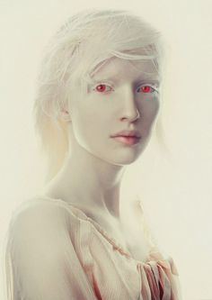 Albinism on emaze