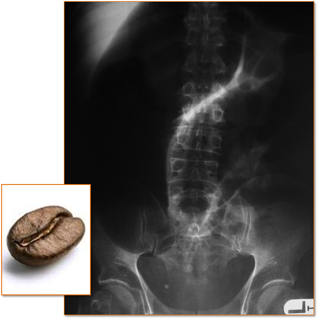 Intestinal Obstruction on emaze