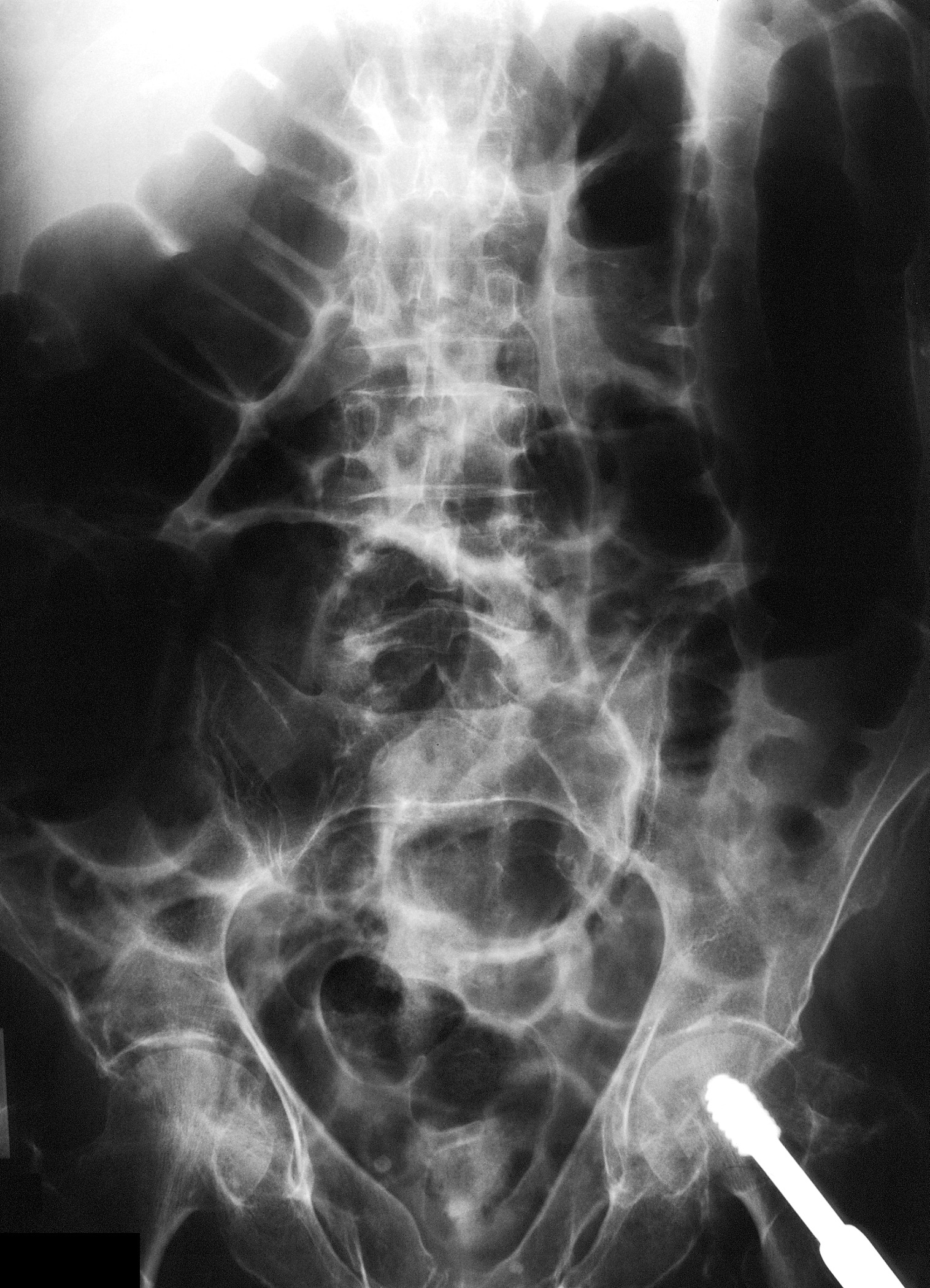 Intestinal Obstruction on emaze