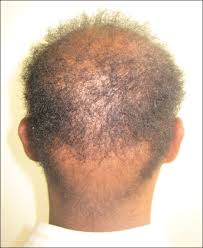 Trichothiodystrophy at emaze Presentation