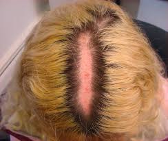 Trichothiodystrophy at emaze Presentation