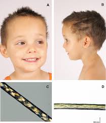 Trichothiodystrophy at emaze Presentation
