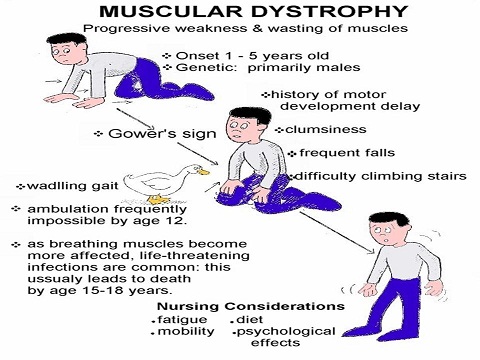 Duchenne Muscular Dystrophy at emaze Presentation