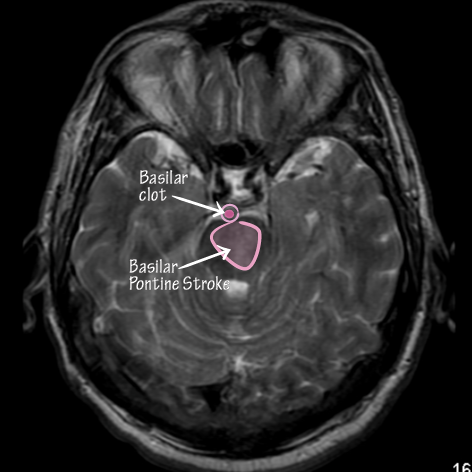 LOCKED-IN SYNDROME on emaze