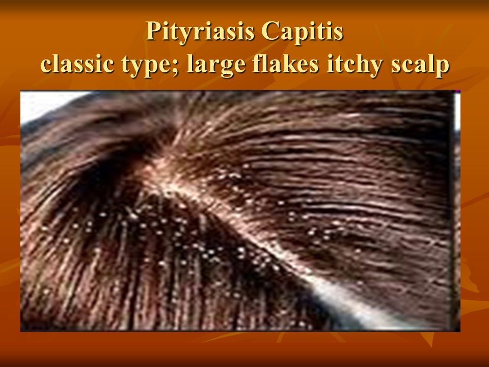describe and explain pityriasis capitis simplex at emaze Photo Album