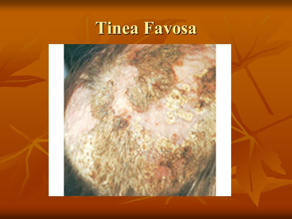 describe and explain pityriasis capitis simplex at emaze Photo Album