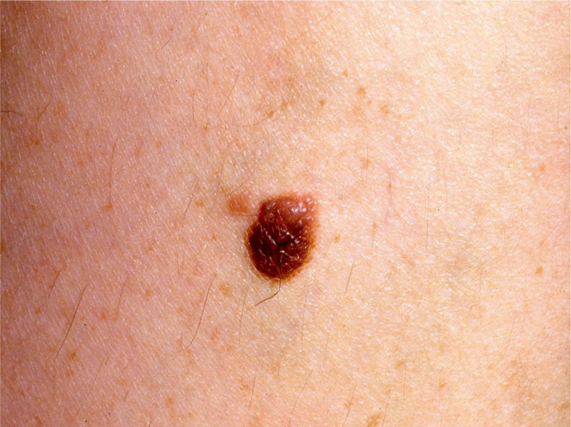 NEVUS MELANOCITICOS on emaze