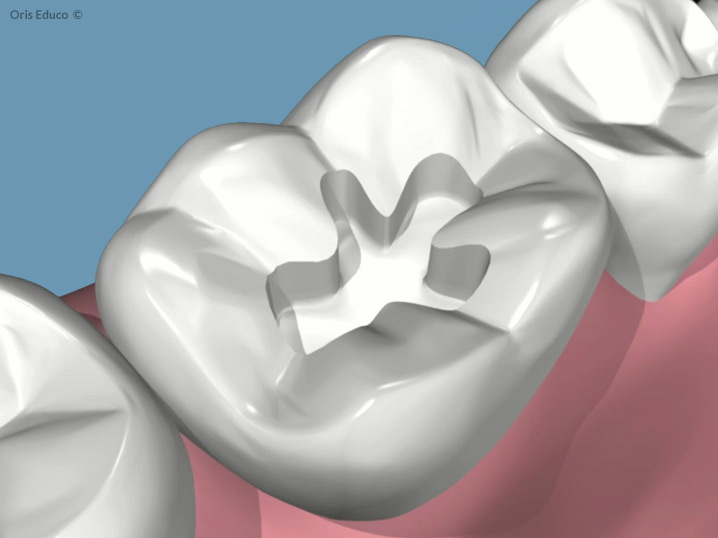 dx lesiones pulpares on emaze