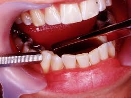 dx lesiones pulpares on emaze