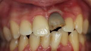 dx lesiones pulpares on emaze