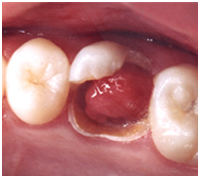 dx lesiones pulpares on emaze