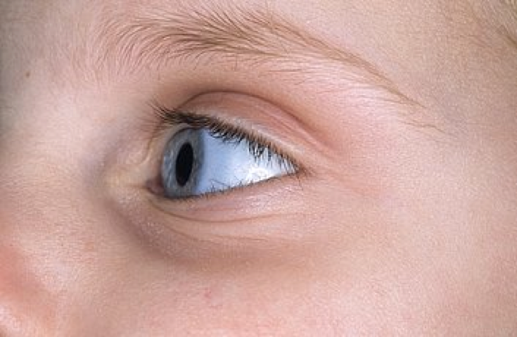 Osteogenesis Imperfecta on emaze