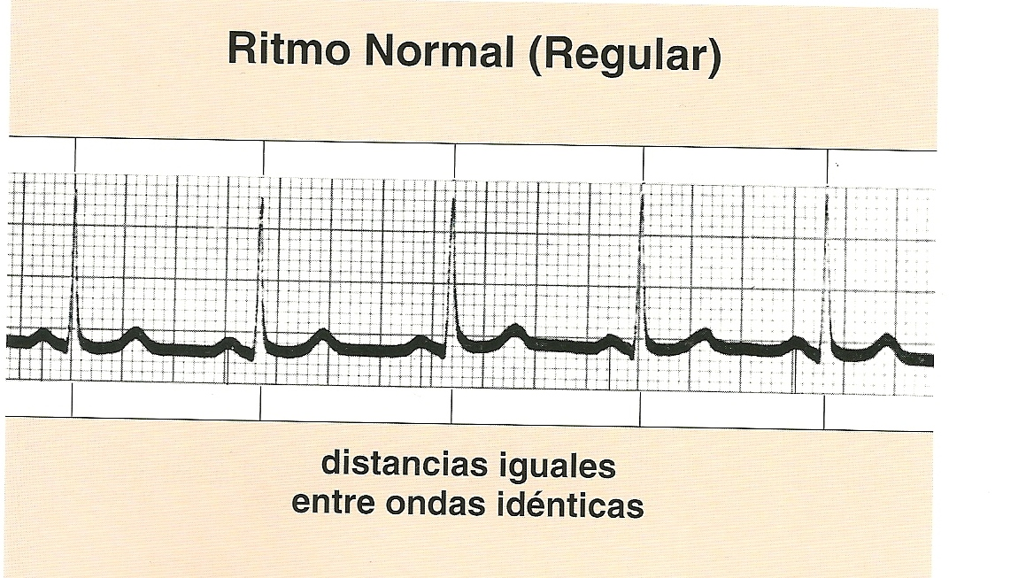 ELECTROCARDIOGRAMA Y ARRITMIAS on emaze