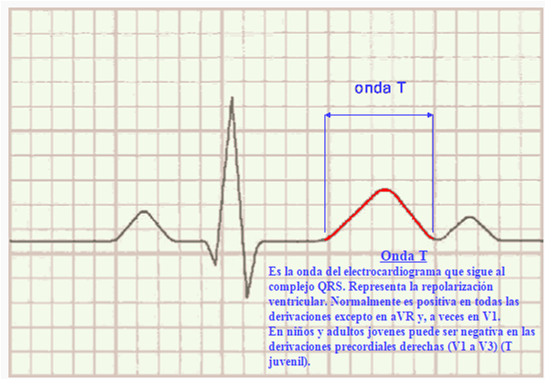 ELECTROCARDIOGRAMA Y ARRITMIAS on emaze