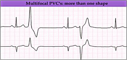ELECTROCARDIOGRAMA Y ARRITMIAS on emaze