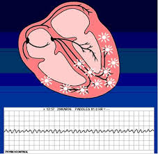 ELECTROCARDIOGRAMA Y ARRITMIAS on emaze