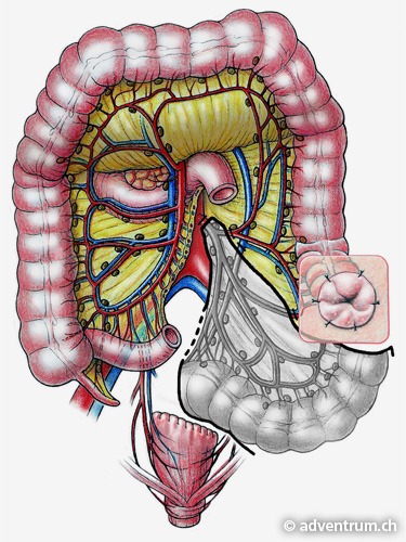 Operation nach Hartmann at emaze Presentation