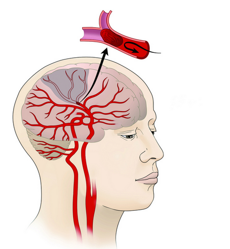 Warfarin Training at emaze Presentation