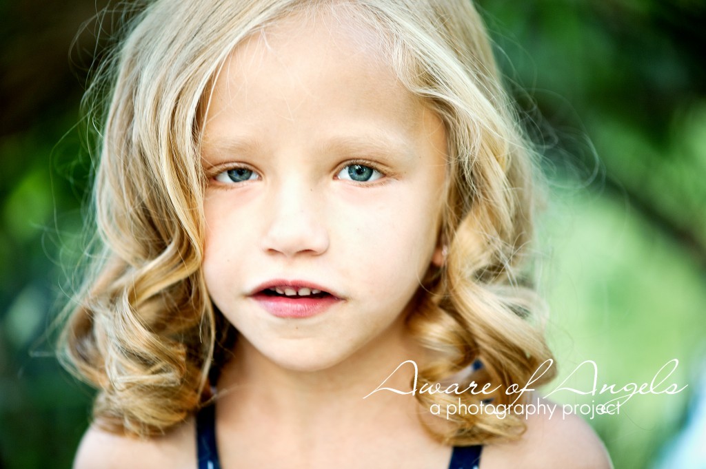 Turners Syndrome On Emaze
