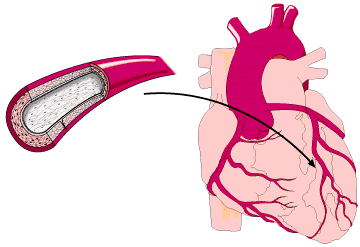 Angina estable crónica on emaze