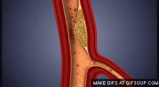 Angina estable crónica on emaze
