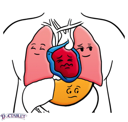 Angina estable crónica on emaze