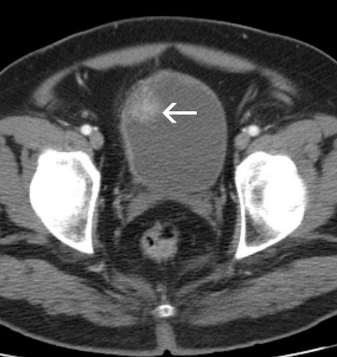 The role of NBI cystoscopy in outpatient setting.pptx at emaze Presentation