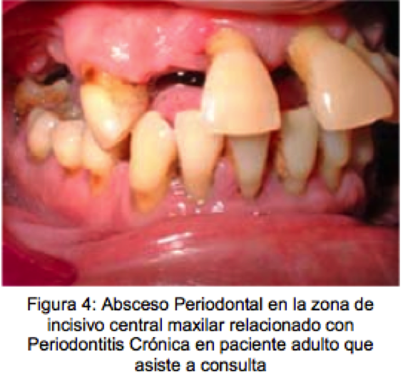 Absceso Periodontal on emaze