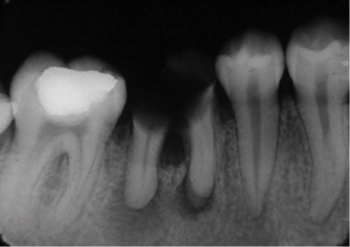 Absceso Periodontal on emaze