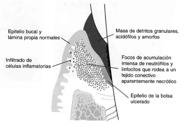Absceso Periodontal on emaze