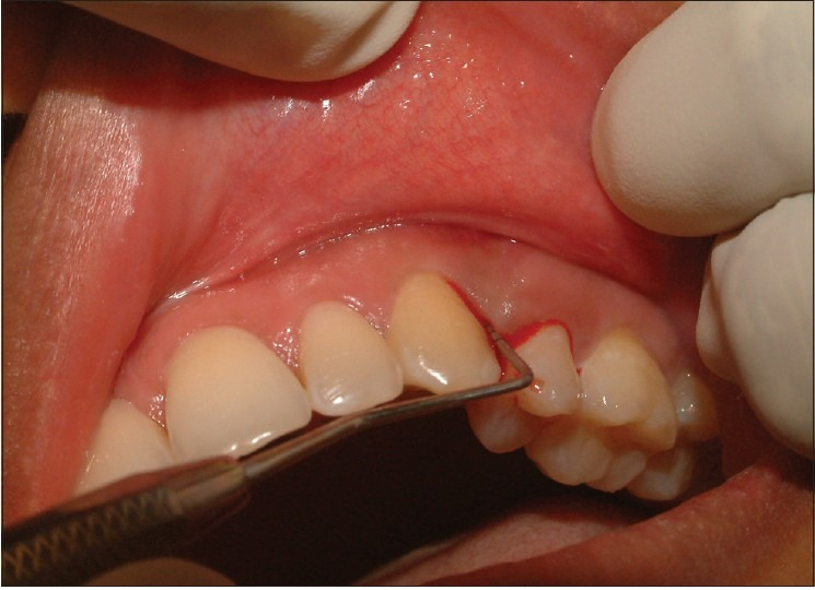 Absceso Periodontal on emaze