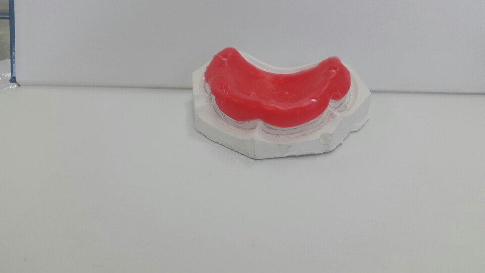 광중합 레진을 이용한 상악 개인트레이 at emaze Presentation