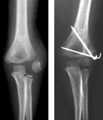 Fractura de humero on emaze