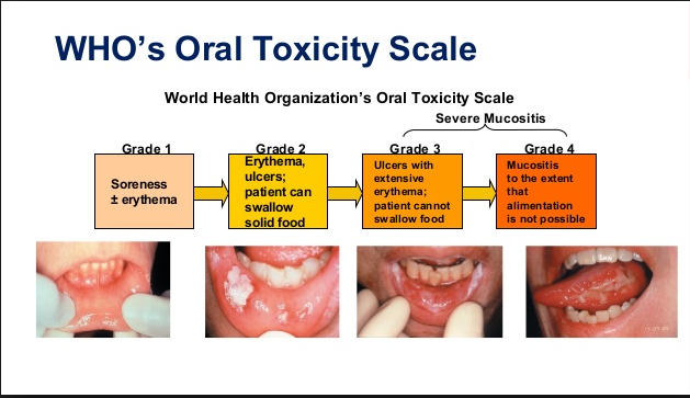 Oral Mucositis on emaze