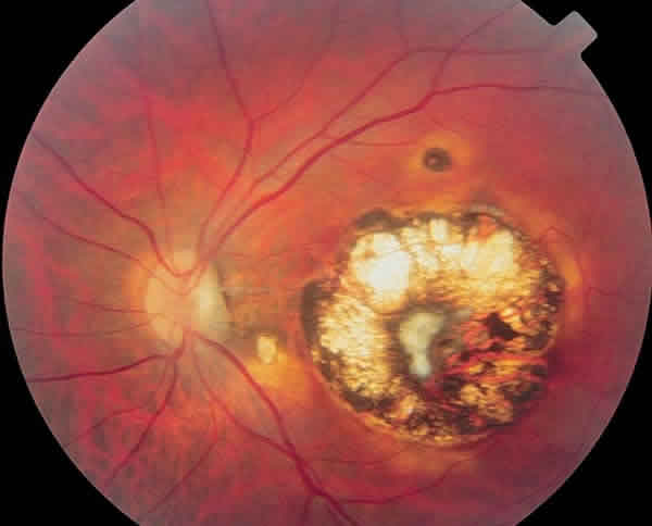 Toxoplasmosis at emaze Presentation