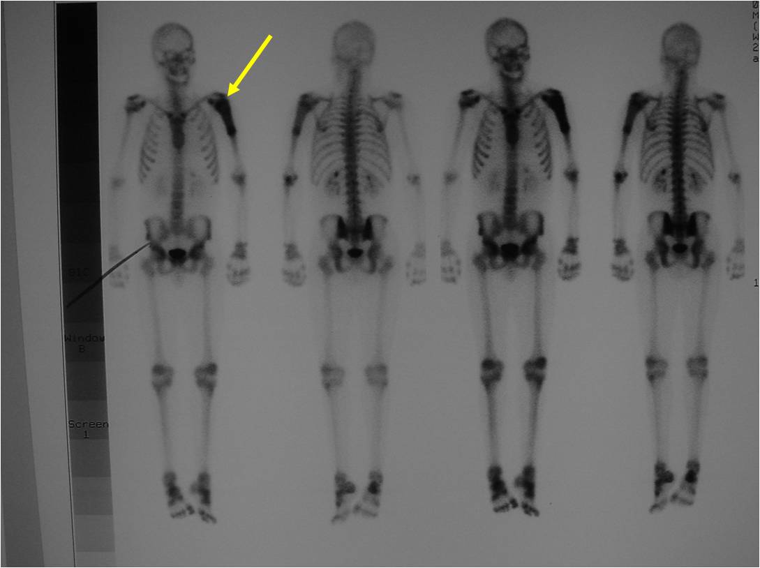 ewing sarcoma.pptx at emaze Presentation