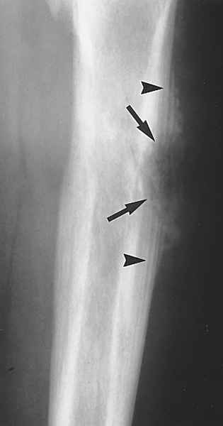 ewing sarcoma.pptx at emaze Presentation