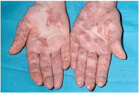 Cirrose Hepática: at emaze Presentation