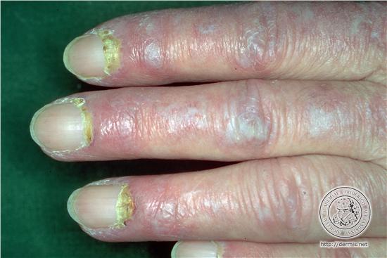 DERMATOMIOSITIS. at emaze Presentation
