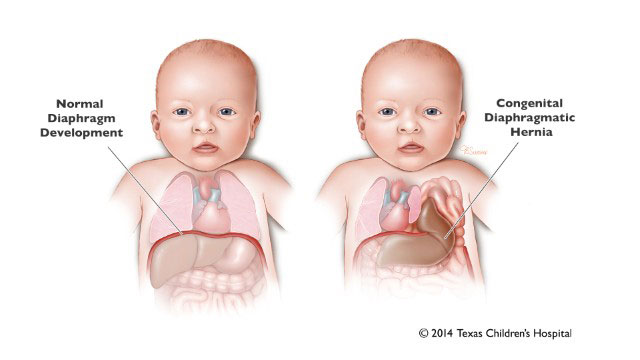 congenital diaphragmatic hernia on emaze