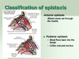 EPISTAXIS on emaze