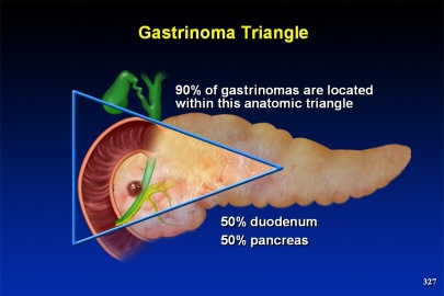 Gastrinoma; Tumor Productor de Gastrina; Tumor Ulcerogénico de los ...