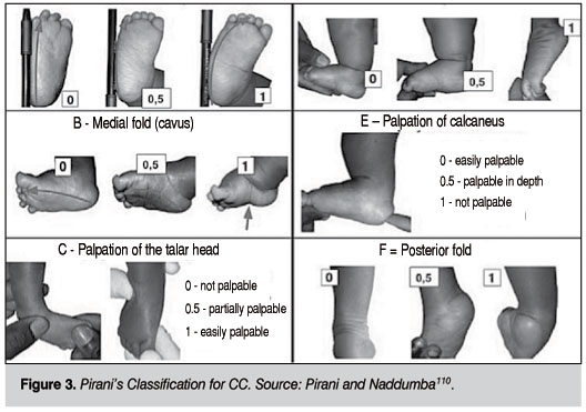 Clubfoot talk on emaze