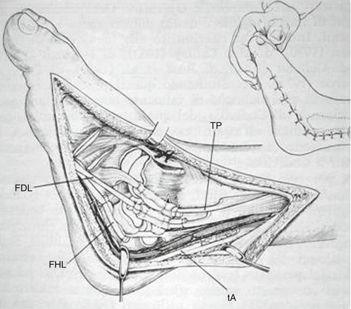 Clubfoot talk on emaze