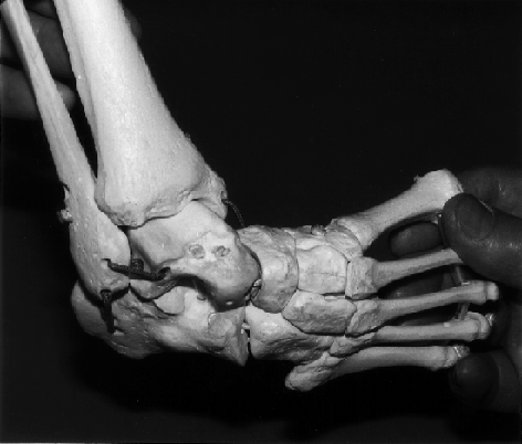 Clubfoot talk at emaze Presentation