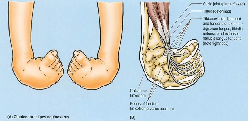 Clubfoot talk at emaze Presentation