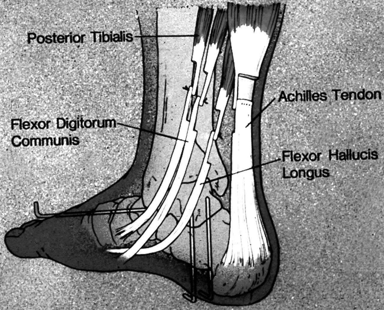 Clubfoot talk on emaze