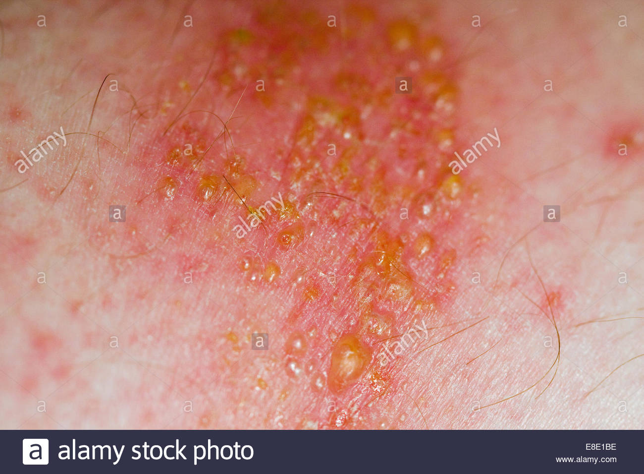 Impetigo at emaze Presentation
