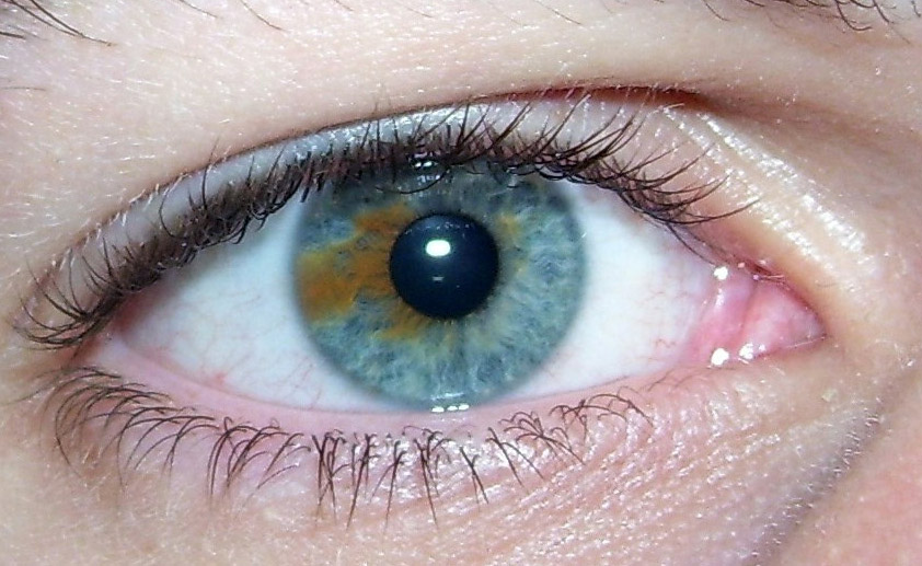 Heterochromia Iridum at emaze Presentation