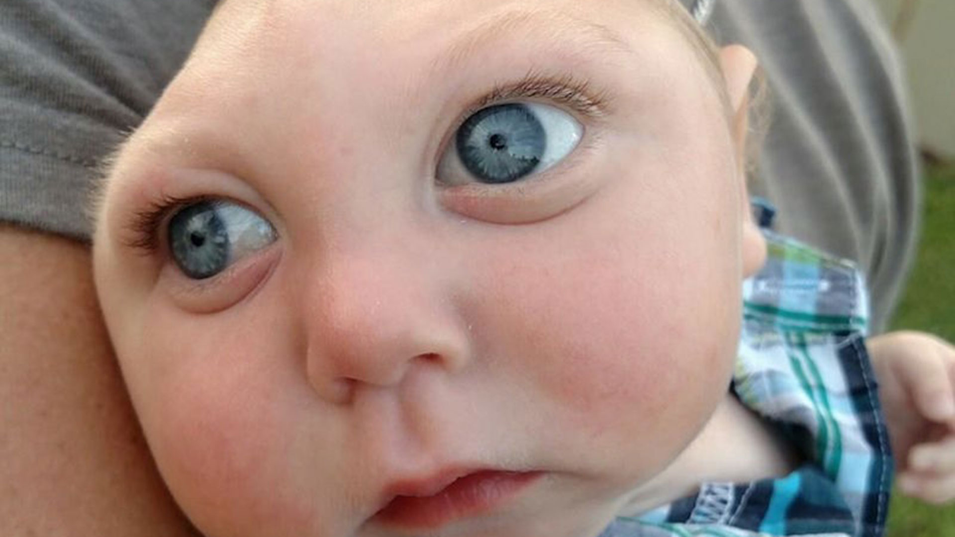 Anencefalia on emaze